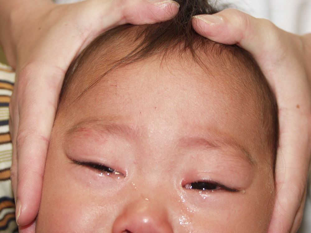 はしか(麻疹)の詳しい説明と写真|写真で見る「子どもの病気」 町医者の家庭の医学